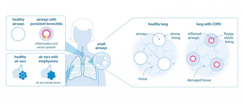The Best Air Purifier for COPD – Buying Guide and Reviews